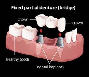 Missing Teeth | Removable Partial Dentures | Fixed Bridges | Implants